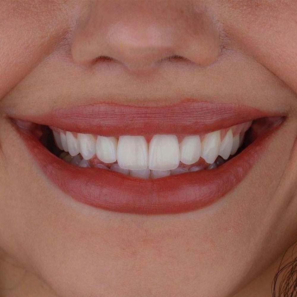 Buck Tooth Smile