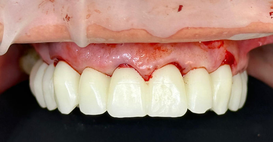 A Comprehensive Look at PMMA Dental Applications | Ceradirect news blog