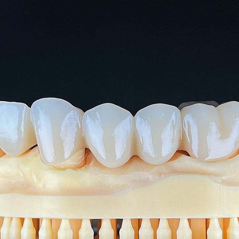 An In-Depth Look at Lithium Disilicate Veneers | Ceradirect Daily ...