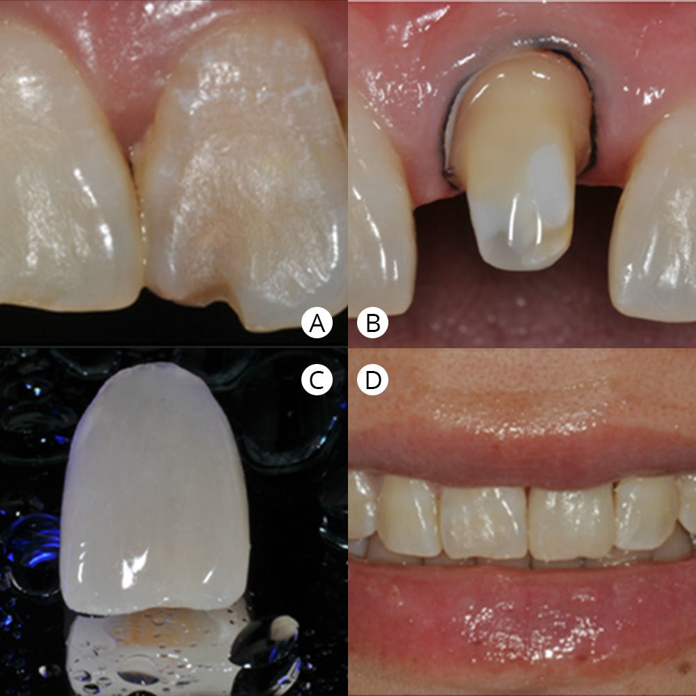 Hybrid Ceramic Multilayer—M14(12*14*18mm)-HT(5 pieces)